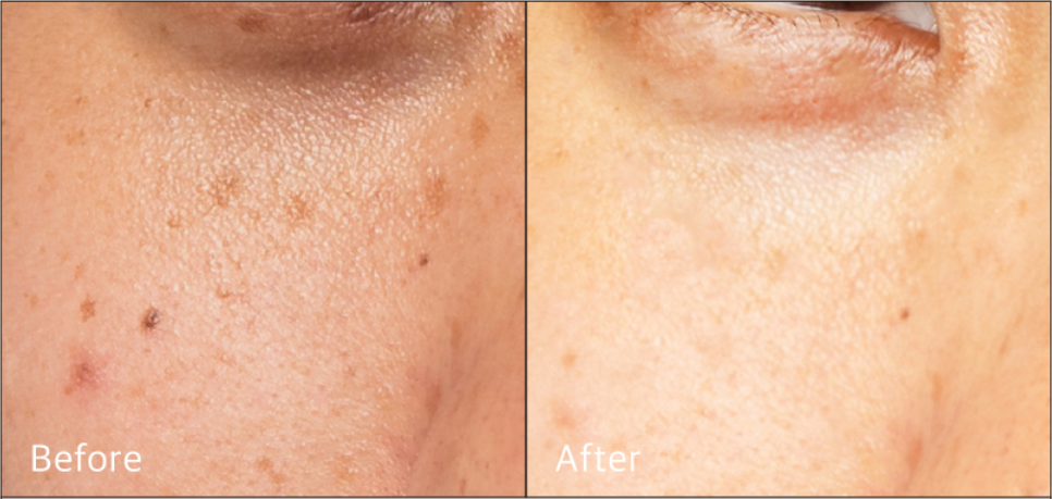 Licorne: Vitafill Toning Pad 170ml/ 70 puder - Velkommen til Namsan